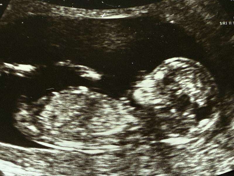 IVF giant under microscope for second embryo mix-up | Campaspe News