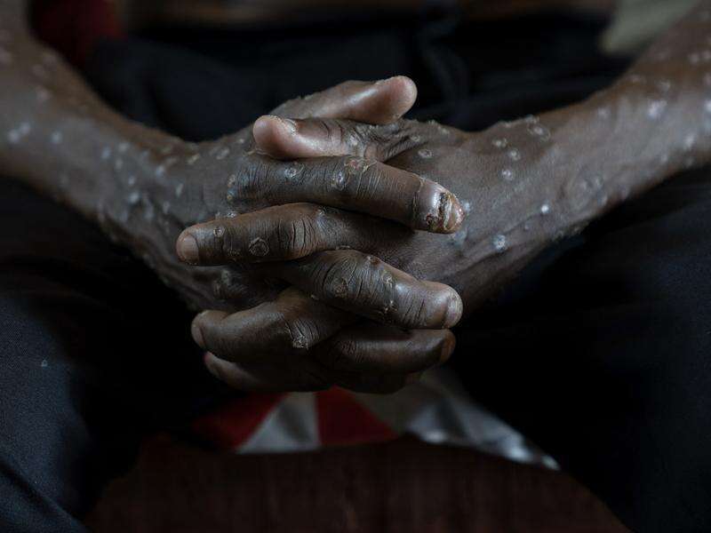 India reports first case of fast-spreading mpox variety | Country News